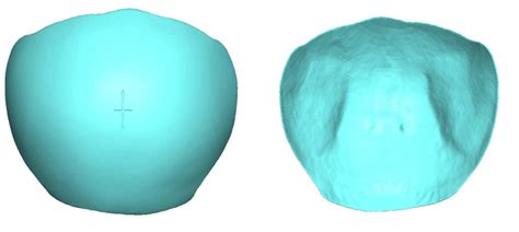 Plastic Surgery Case Study Custom Skull Implant For Coverage Of