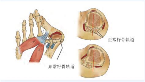 北京圣嘉新医院的陈圣英做拇外翻手术怎么样？ 哔哩哔哩