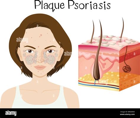 Human Anatomy Of Plaque Psoriasis Illustration Stock Vector Image And Art