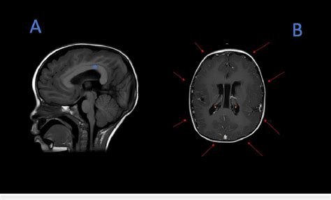 A Mri T1 Sequence Shows Thickening Of The Corpus Callosum Blue