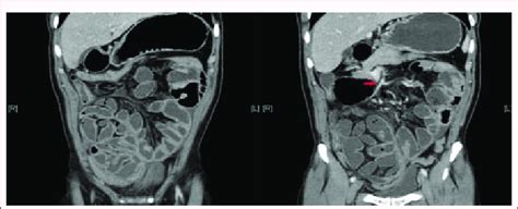 Contrast Enhanced Computed Tomography Of The Abdomen And Pelvis Download Scientific Diagram