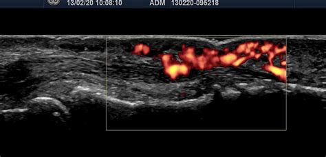 Palmar Longitudinal Scan Of Mcp And Pip Joint In A Patient With Psa