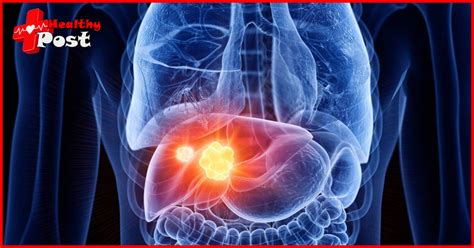 6 Major Symptoms Of Liver Cancer