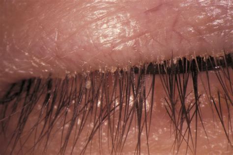 Staphylococcal Blepharitis