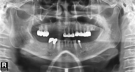 Dental Implant Product L Csm Implant