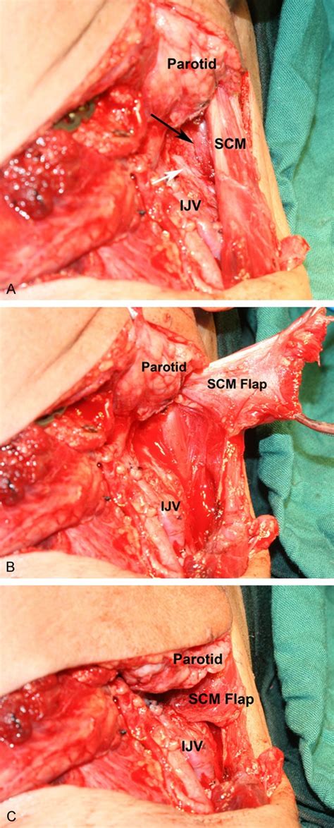 Sternocleidomastoid Muscle Flap Used For Repairing The Dead Space After Supraomohyoid Neck