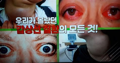 미라클푸드125회 갑상선의모든것 갑상선기능항진증vs갑상선기능저하증 구분and증상and자가진단법and신체이상신호and방치시위험질환 갑상선건강지키는법 관리법 네이버 블로그