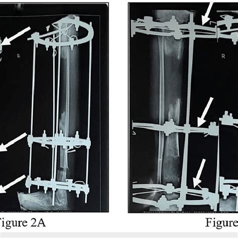 Check X Rays Of The Right Lower Leg With Ilizarov Ring Fixator In Situ Download Scientific