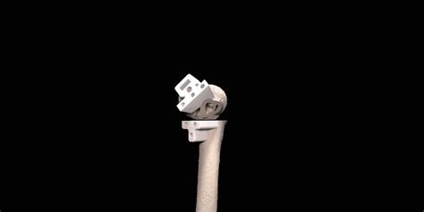 Proximal Femur Osteotomy 3d Lab