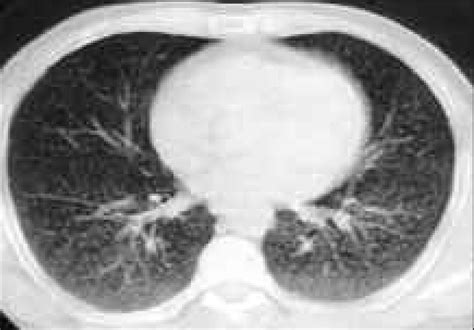 Multiple Centrilobular Nodules Throughout Both Lung Fields With No
