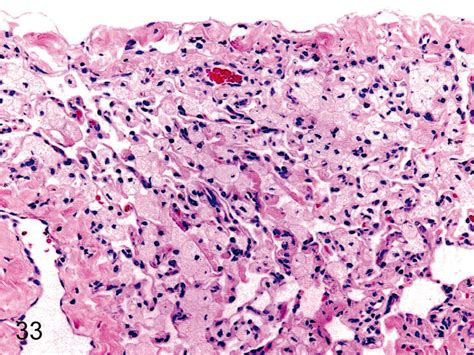 Lung Accumulation Of Foam Cells In The Alveolus Foam Cells