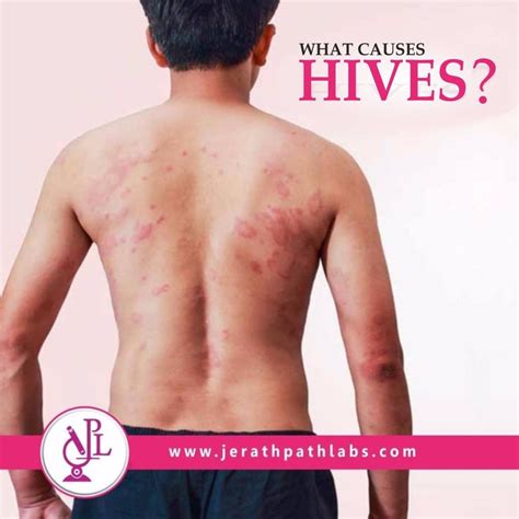 An Allergic Reaction Can Trigger Hives Things That Commonly Trigger An Allergic Reaction