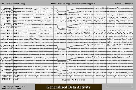 Ppt Normal Eeg Patterns Powerpoint Presentation Free Download Id