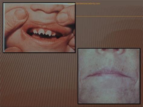Oral Manifestations Of Sexually Transmitted Diseases Dental Courses
