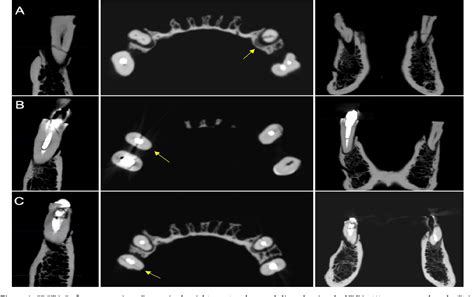 Figure 1 From Accuracy Of Cone Beam Ct In Detecting Vertical Root