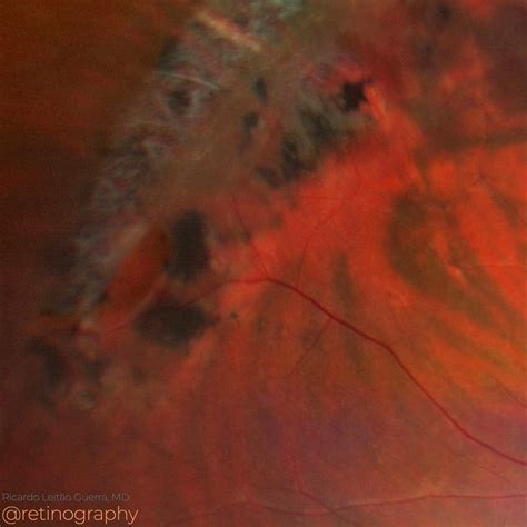 Peripheral Retinal Tears Associated With Lattice Degeneration Are Best