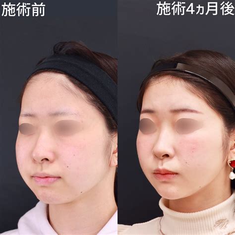【糸リフト×脂肪除去】お顔の厚みが減ってスッキリ小顔に！｜症例写真・ビフォーアフター｜美容整形･美容外科のtaクリニックグループ