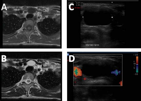 Thyroglossal Duct Cyst