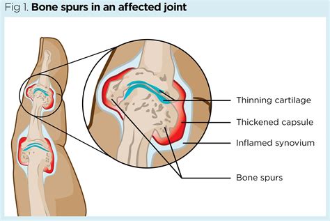 Osteoarthritis Key Features And How To Support Patients With The