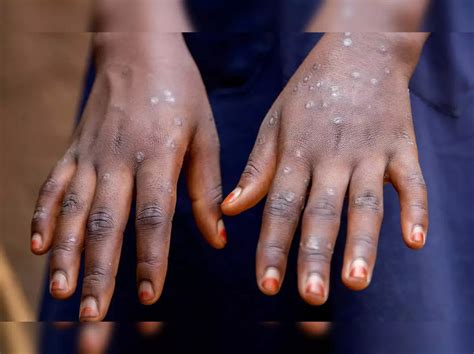 Mpox Clade 1b India Kerala Takes Immediate Action After First Case