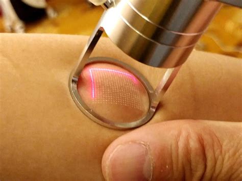 Co2 Laser