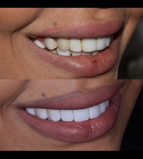 Dr Ezz On Linkedin New Smile Makeover For One Of Our Valuable Patients
