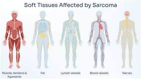 Soft Tissue Sarcoma Symptoms Rgcc North America