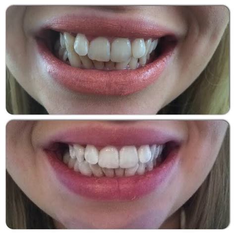 Patchy Teeth Whitening Rdentistry