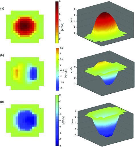 Bidirectional Csf Flow In Cerebral Aqueduct Of An Inph Patient Ids