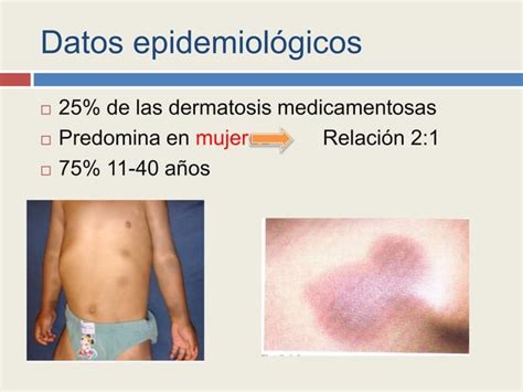 Eritema Pigmentado Fijo Y Eritema Morbiliforme Pptx