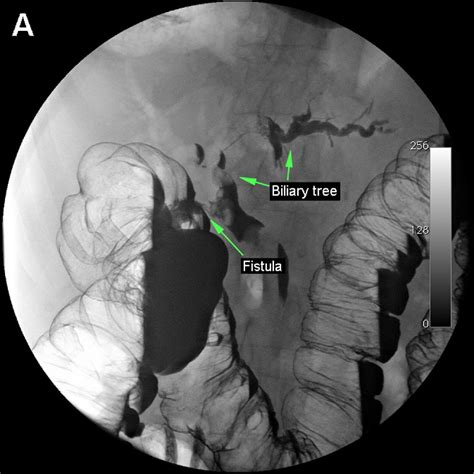 Biliary Colonic Fistula Clinical Gastroenterology And Hepatology