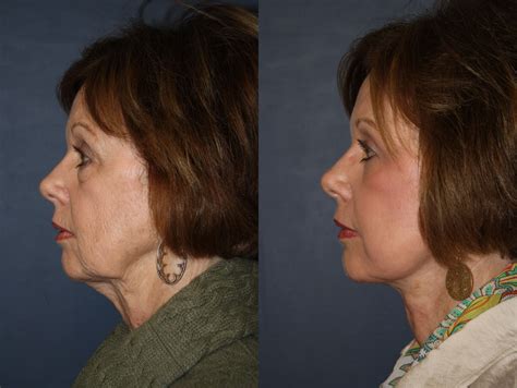 This 65 Year Young Lady Underwent The Cheek And Neck Lift Procedure
