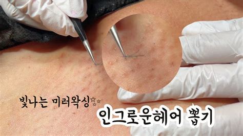 [인그로운 헤어 제거 전문]면도 후 왁싱 ️ ️ 인그로운헤어 영상확인필수 미러왁싱 Youtube