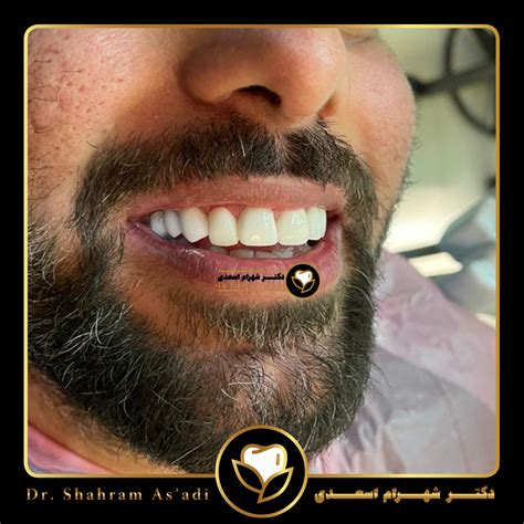 ایمپلنت با لیزر ایمپلنت لیزری ایمپلنت دندان کاشت ایمپلنت دندان هزینه ایمپلنت با لیزر
