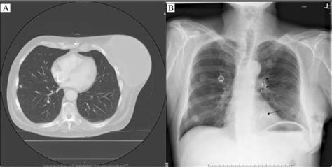 Refractory Bleeding From A Chest Wall Sarcoma Made Palliative Resection