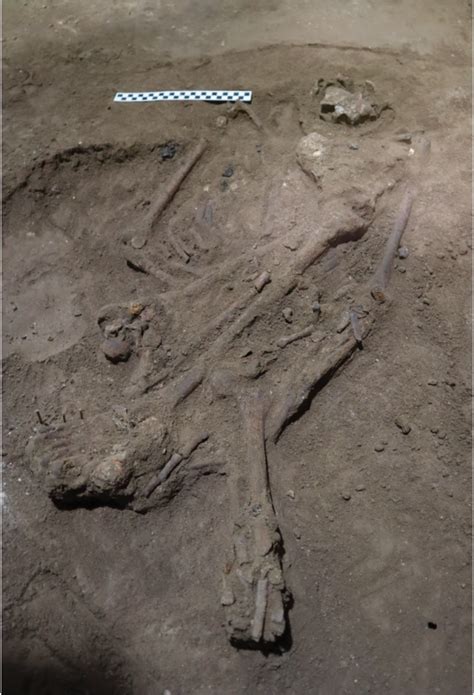 Worlds Oldest Evidence Of Surgical Amputation Lay Hidden For 31000