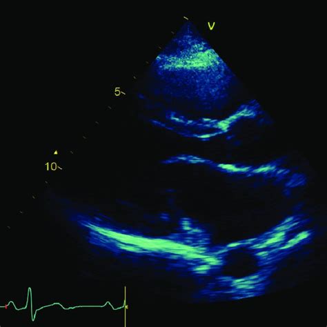 Percutaneous Transmitral Commissurotomy Shows Inflated Balloon Across