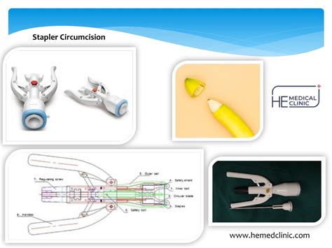 PPT - Stapler circumcision in Malaysia PowerPoint Presentation, free ...