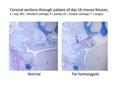 Pdf Far Ectopic Cartilage