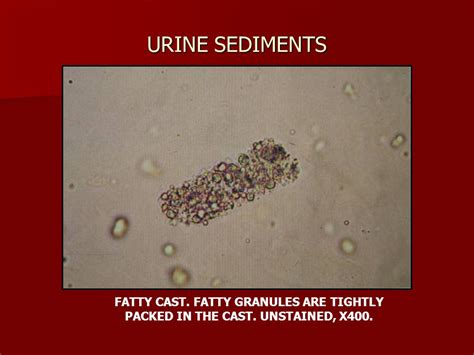 Waxy Cast Urine
