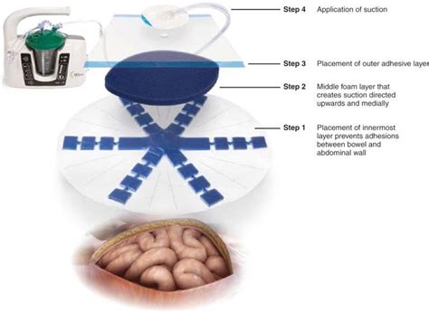 Temporary Closure Of The Abdomen Clinical Tree