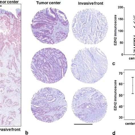 Comparison Of Ezh2 Staining Intensity In Tumor Center And At The