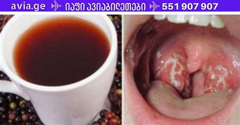 ექიმმა გაუზიარა რჩევა თუ როგორ უნდა მოვიშოროთ ყელის ინფექცია სულ რაღაც 4 საათში