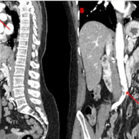 Computerized Tomography With Contrast Angiography Of The Abdominal