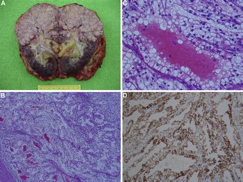 Representative Pictures Of The Nephrectomy Specimen A A Soft Tumor