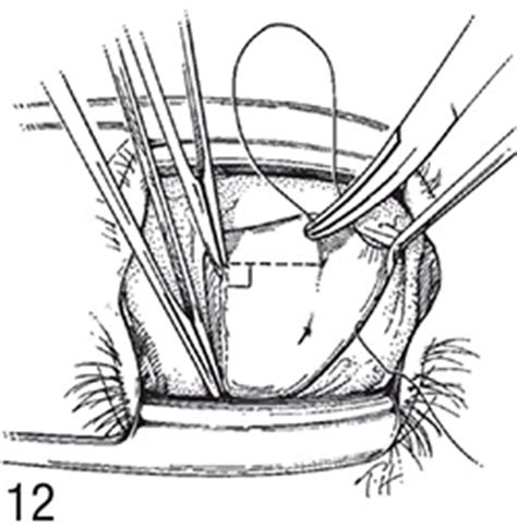 My 10 Commandments For Strabismus Surgery