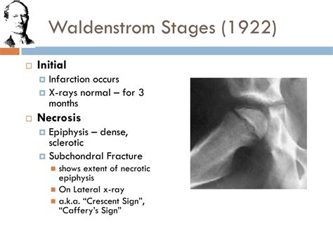 Ppt Legg Calve Perthes Disease Powerpoint Presentation Free