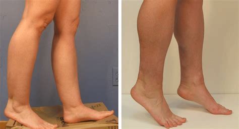 Before And After Calf Treatment1png