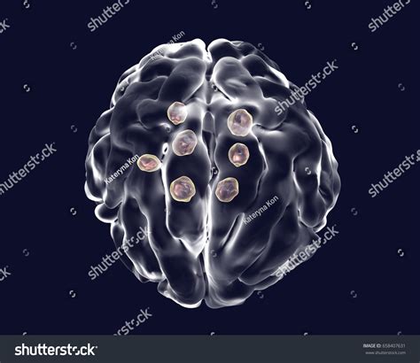 Multiple Cryptococcal Cysts Brain Cryptococcoma 3d Stock Illustration