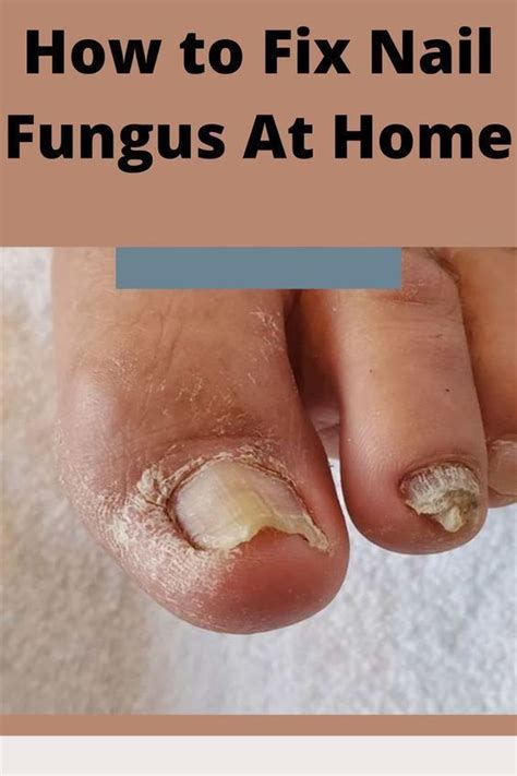 Nail Polish Recipe To Kill Fungus Naturally Instantlythis Is Going To